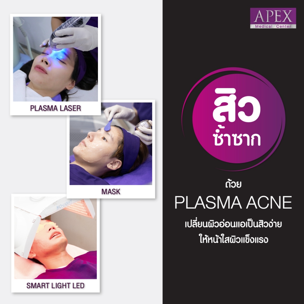 [E-Voucher] APEX Plasma acne เลเซอร์ช่วยลดการเกิดสิว ผลัดเซลล์ผิว ลด ...